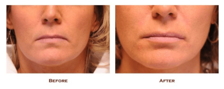Top 12 areas Botox is used Aesthetically from the neck up - Artistik Beauty